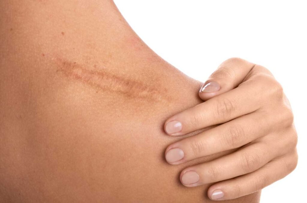 The Path to Flawless Texture Through Advanced Scar Procedures - Mason ...